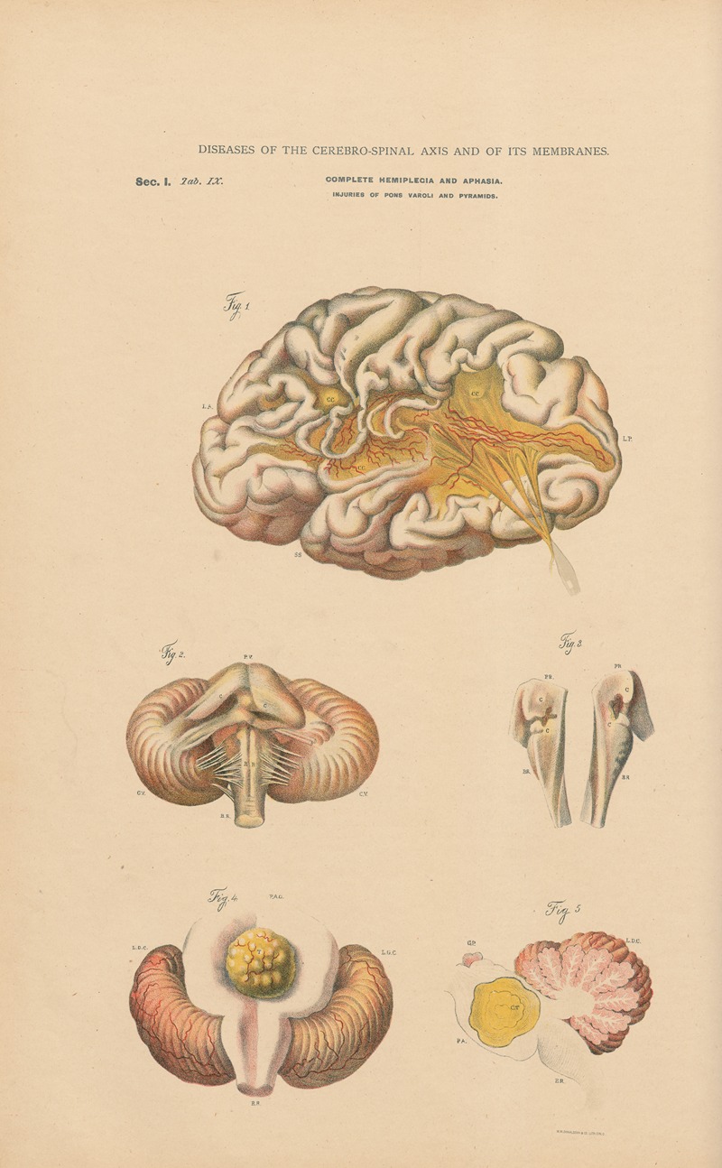 Complete right sided hermiplegia and aphasia. Injuries of the Pons ...